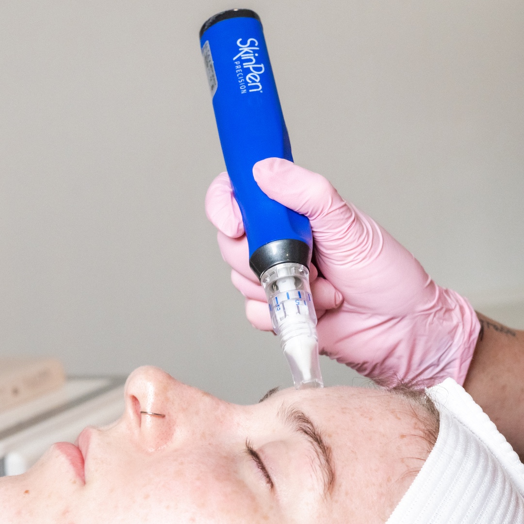 Microneedling with SkinPen – What to Expect